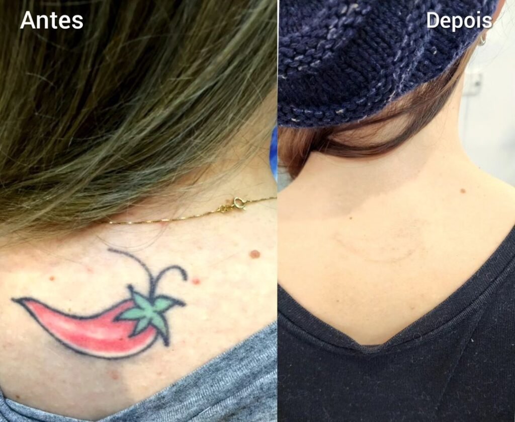 Arquivos pós-sessão remoção de tatuagem - Hell Tattoo - Especialistas ... Arquivos pós-sessão remoção de tatuagem - Hell Tattoo - Especialistas ...