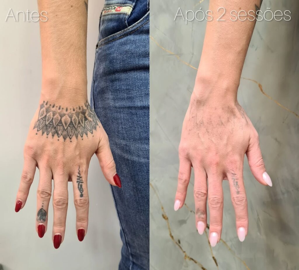 qual-e-o-resultado-de-duas-sessoes-de-remocao-de-tatuagem-04 - Hell ...
